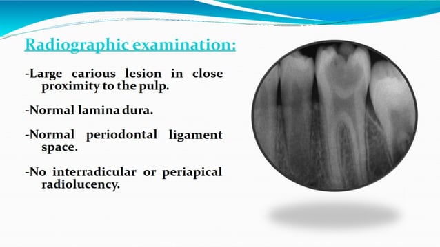 Pulp capping agents and procedures by Dr Islam Alsakkaf | PPTX