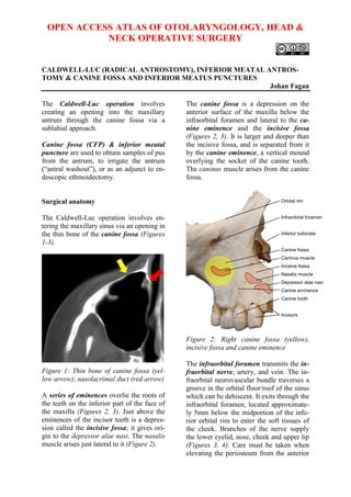 Caldwell Luc _radical antrostomy_ procedure canine fossa and inferior ...