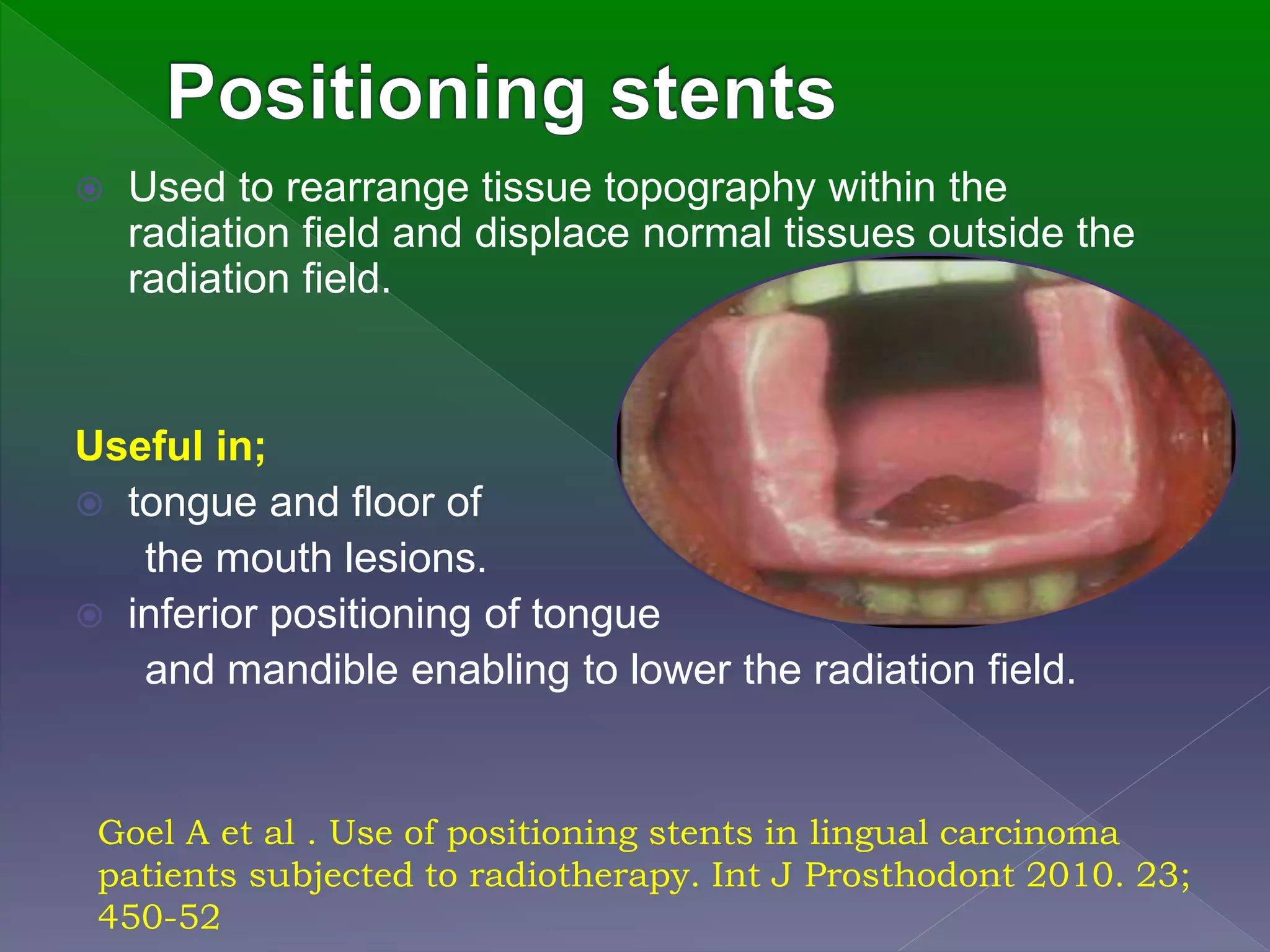 Radiation therapy and its prosthodontic implications | PPTX