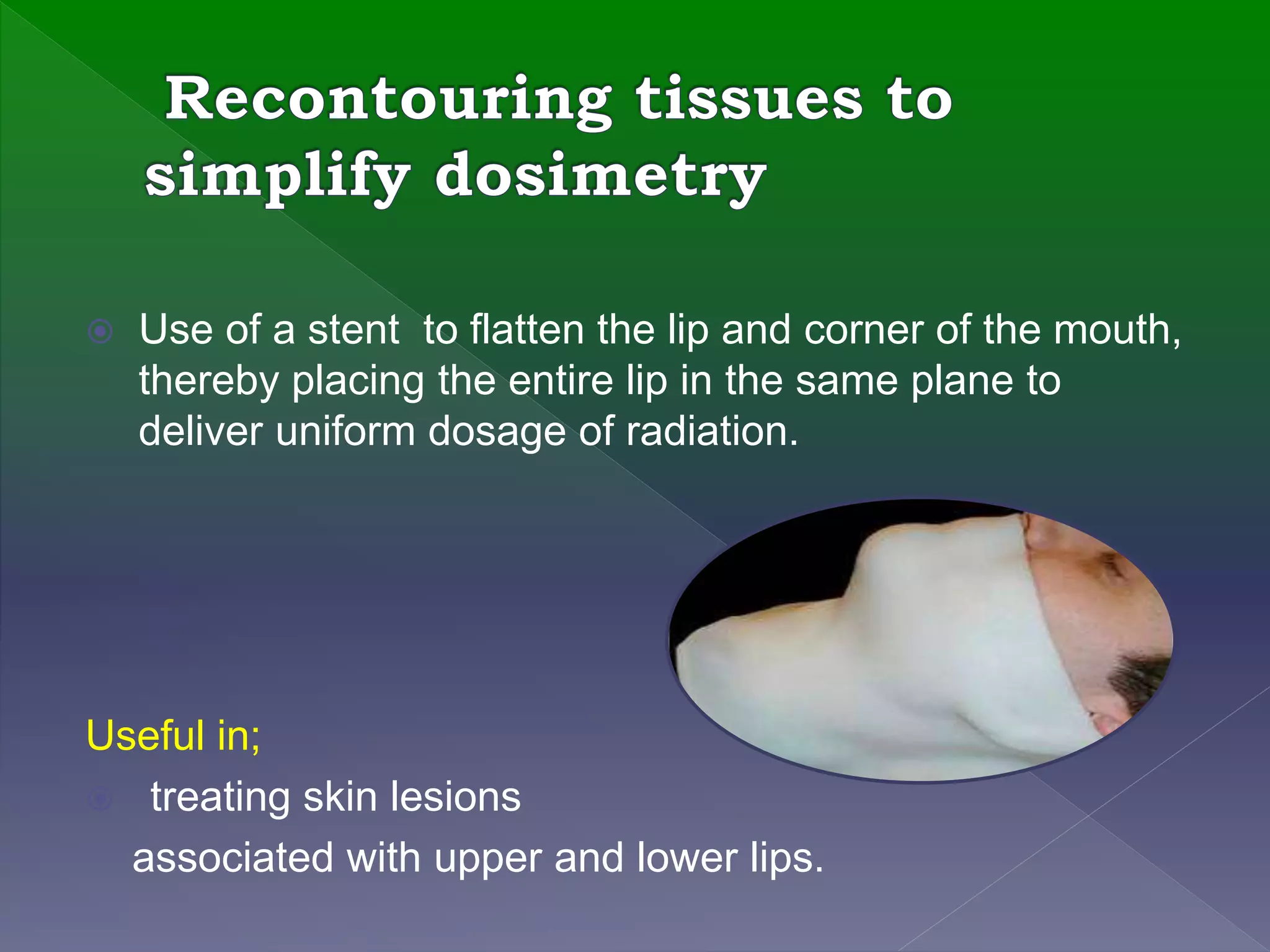 Radiation therapy and its prosthodontic implications | PPTX