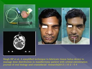 Radiation therapy and its prosthodontic implications | PPTX