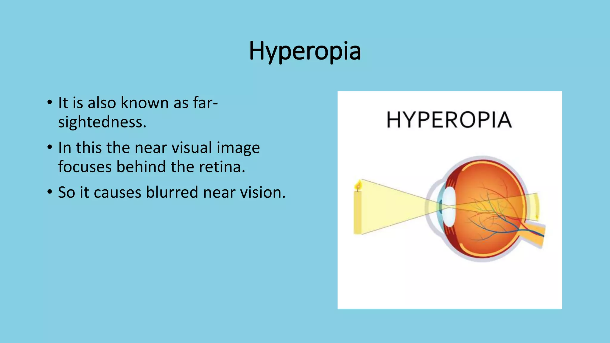 Refractive error | PPTX