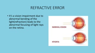 Refractive error | PPTX