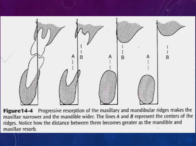 RESIDUAL RIDGE RESORPTION in complete denture | PPTX