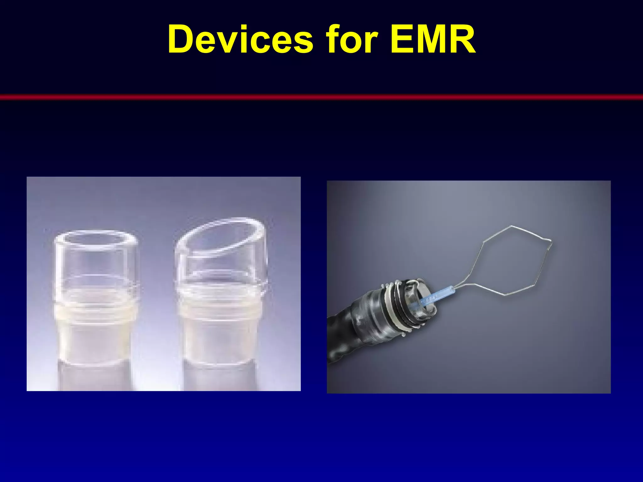 2 rex barretts esophagus | PPT