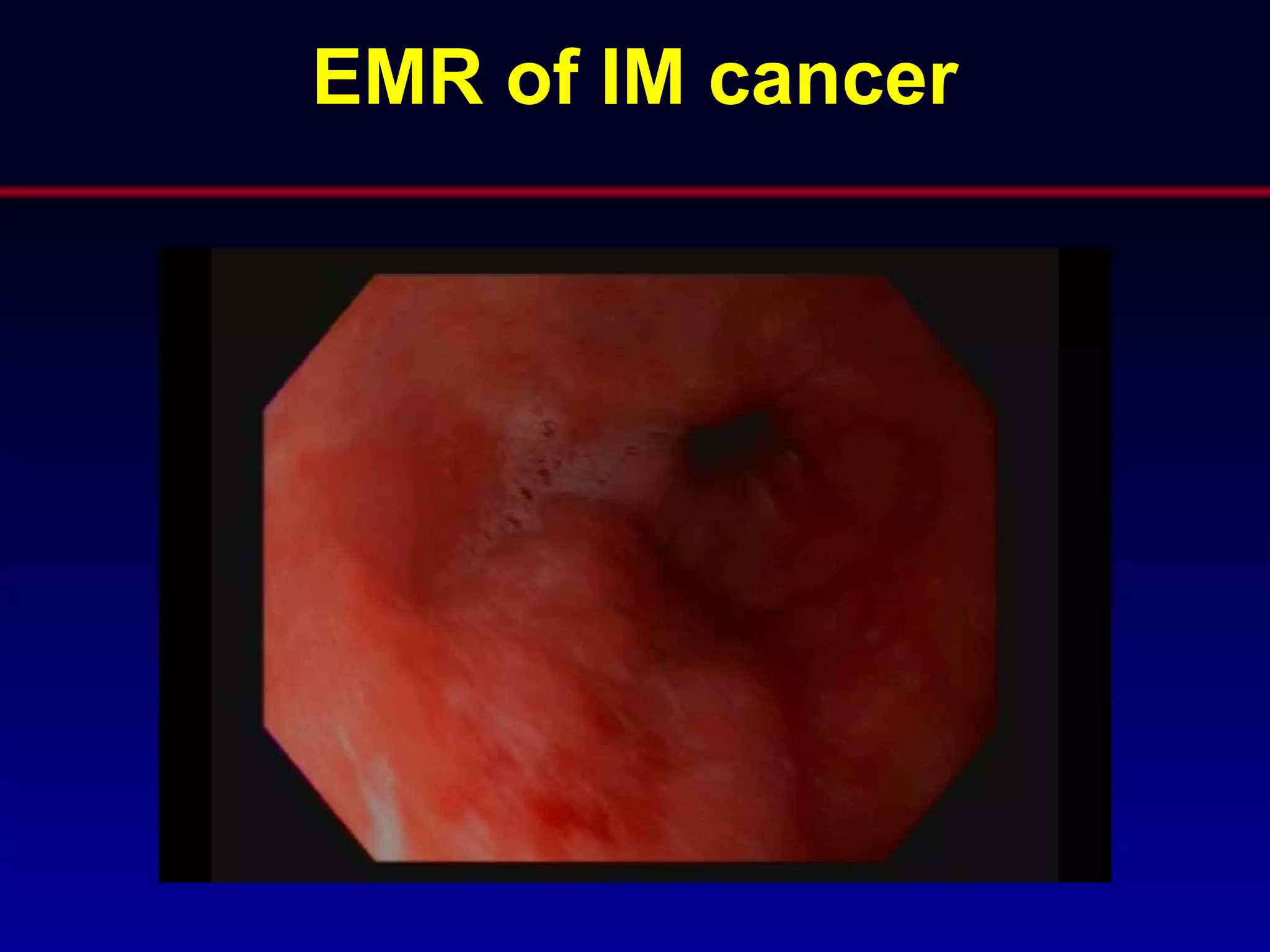 2 rex barretts esophagus | PPT