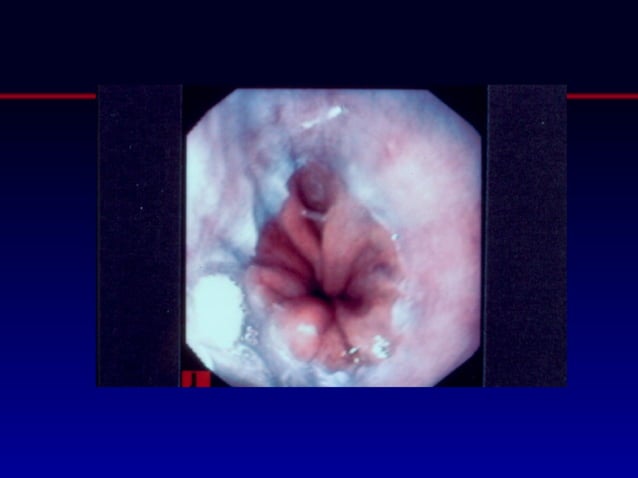 2 rex barretts esophagus | PPT