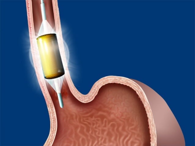 2 rex barretts esophagus | PPT