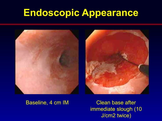 2 rex barretts esophagus | PPT