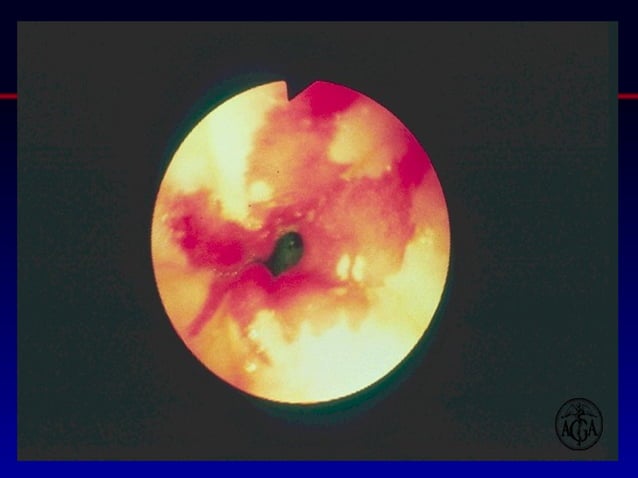 2 rex barretts esophagus | PPT