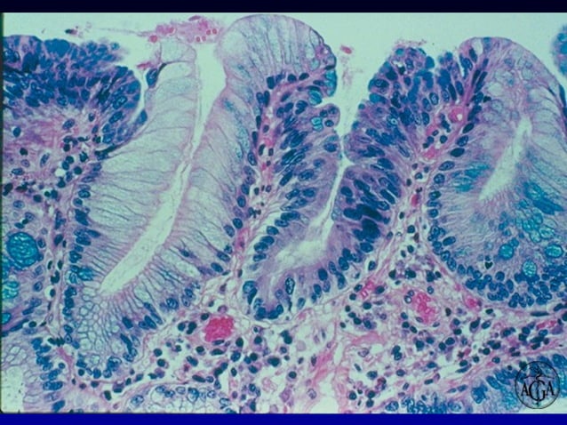 2 rex barretts esophagus | PPT