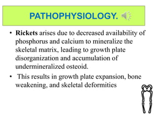 RICKETS IN CHILDREN | PPTX