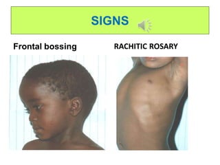 RICKETS IN CHILDREN | PPTX