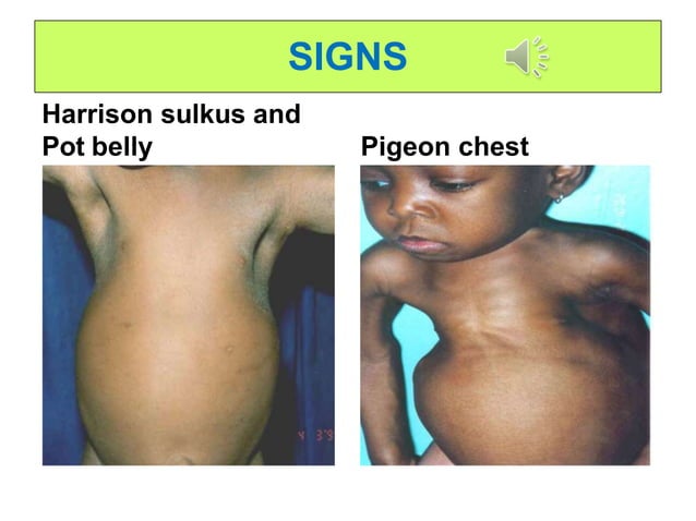 RICKETS IN CHILDREN | PPTX | Bone and Joint Conditions | Diseases and ...