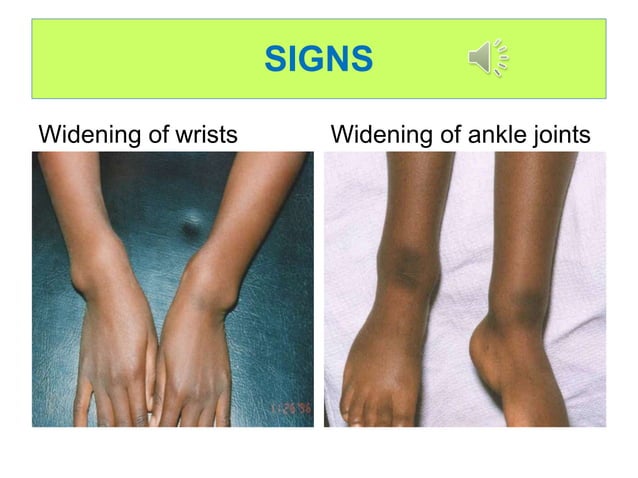 RICKETS IN CHILDREN | PPTX | Bone and Joint Conditions | Diseases and ...