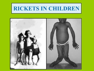 RICKETS IN CHILDREN | PPTX