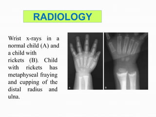 RICKETS IN CHILDREN | PPTX