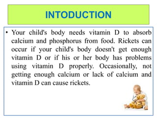 RICKETS IN CHILDREN | PPTX