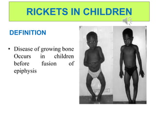 RICKETS IN CHILDREN | PPTX