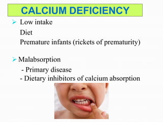 RICKETS IN CHILDREN | PPTX