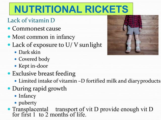 RICKETS IN CHILDREN | PPTX | Bone and Joint Conditions | Diseases and ...