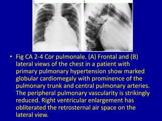 2 right ventricular enlargement | PPTX