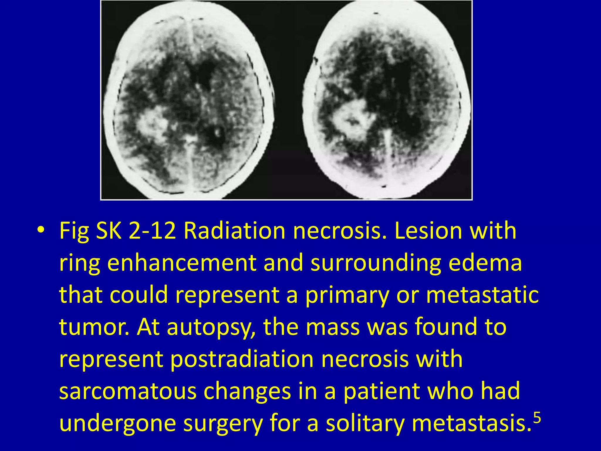 2 ring enhancing lesions | PPTX