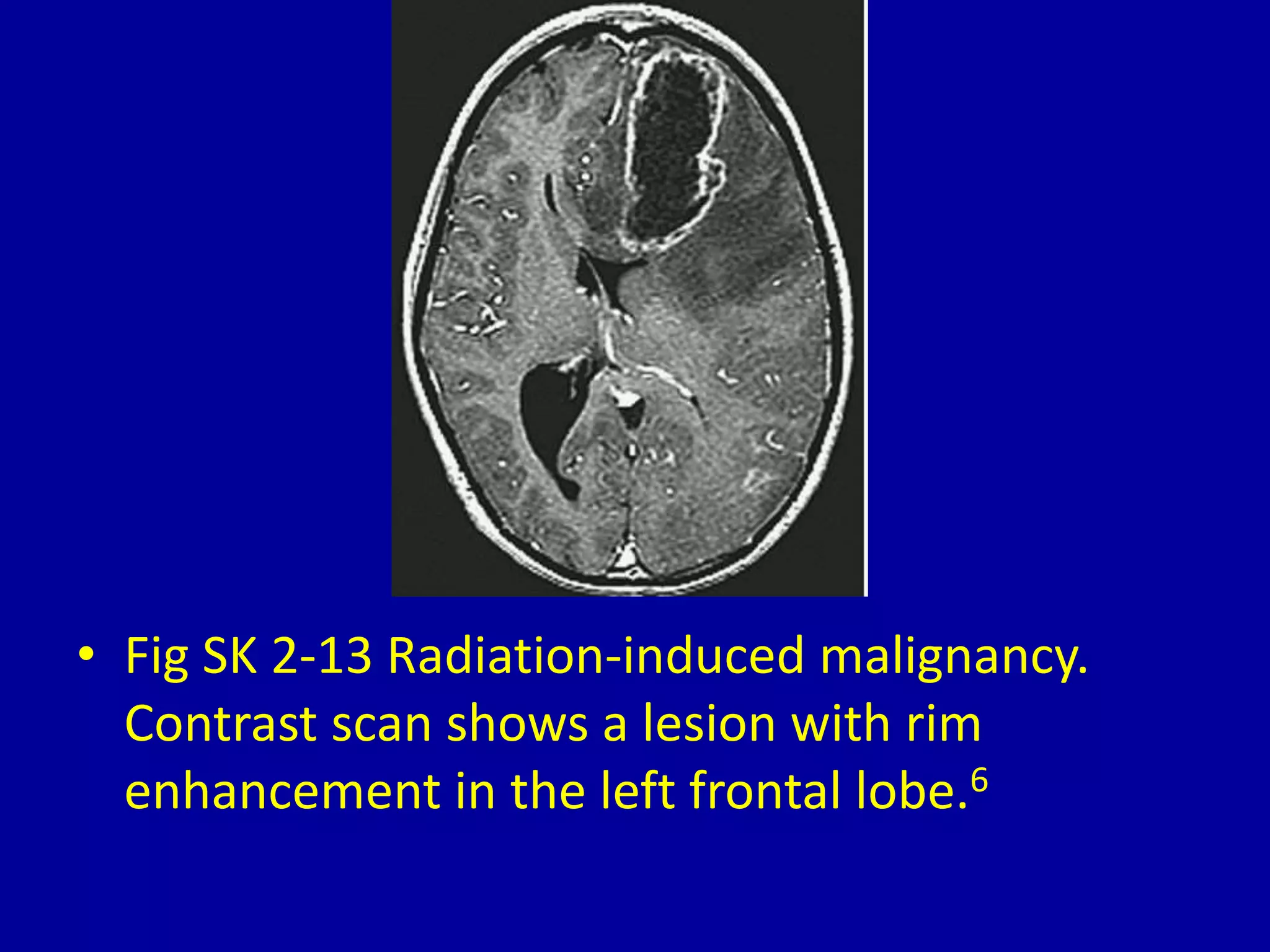 2 ring enhancing lesions | PPTX