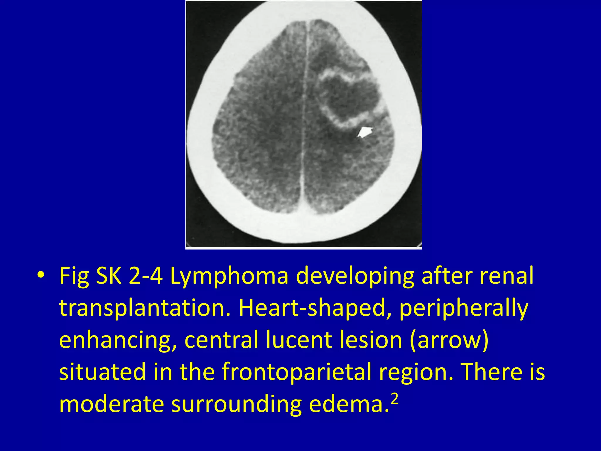 2 ring enhancing lesions | PPTX