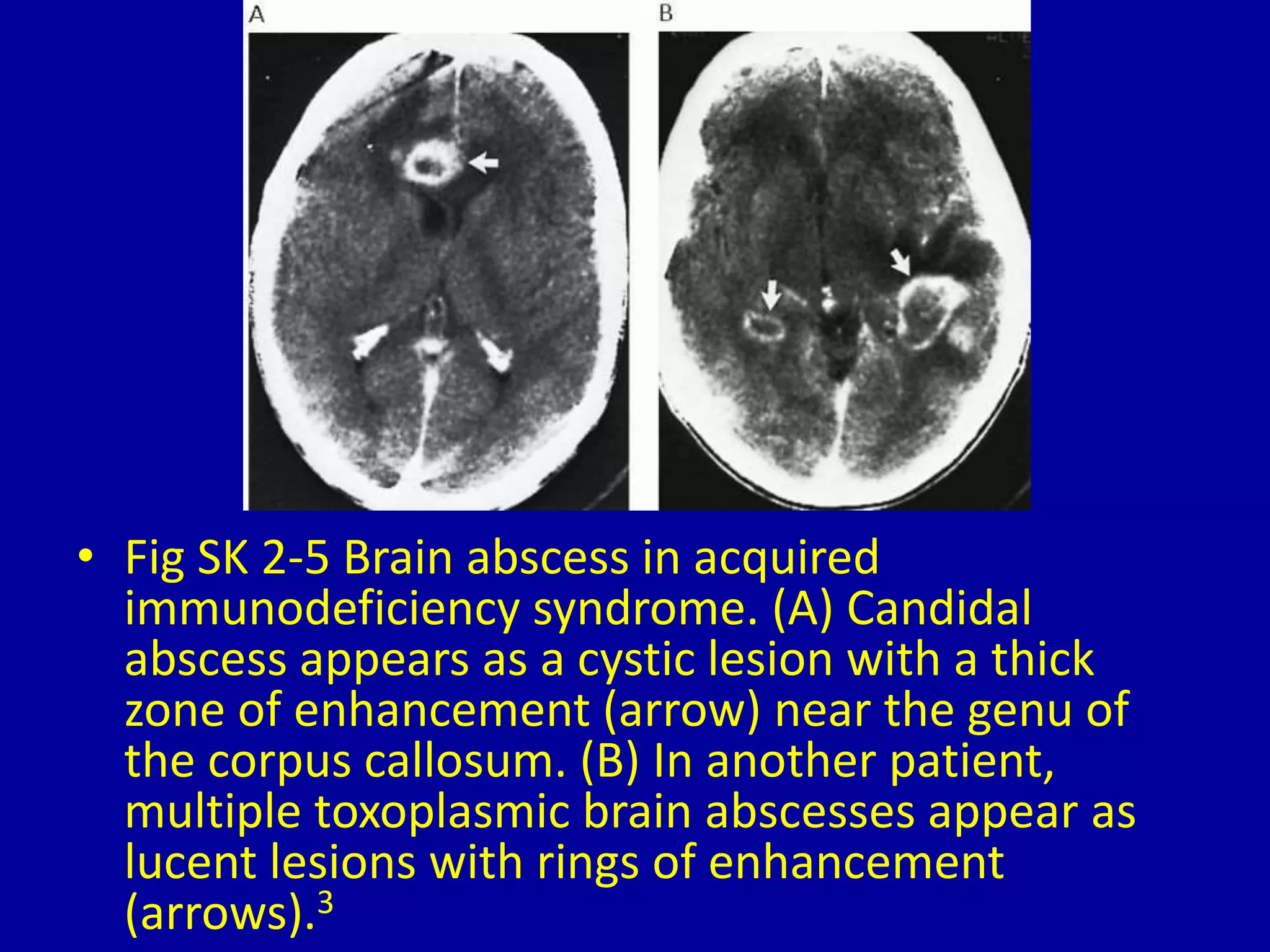 2 ring enhancing lesions | PPTX