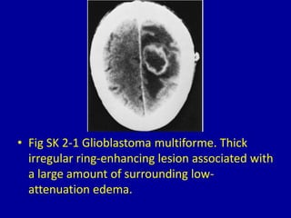 2 ring enhancing lesions | PPTX