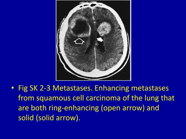 2 ring enhancing lesions | PPTX | Cancer | Diseases and Conditions