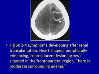 2 ring enhancing lesions | PPTX