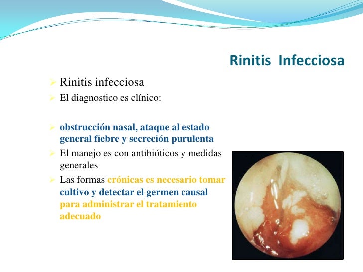 ¿Qué Es La Rinitis Infecciosa : Rinitis: qué es, síntomas y tratamiento ...