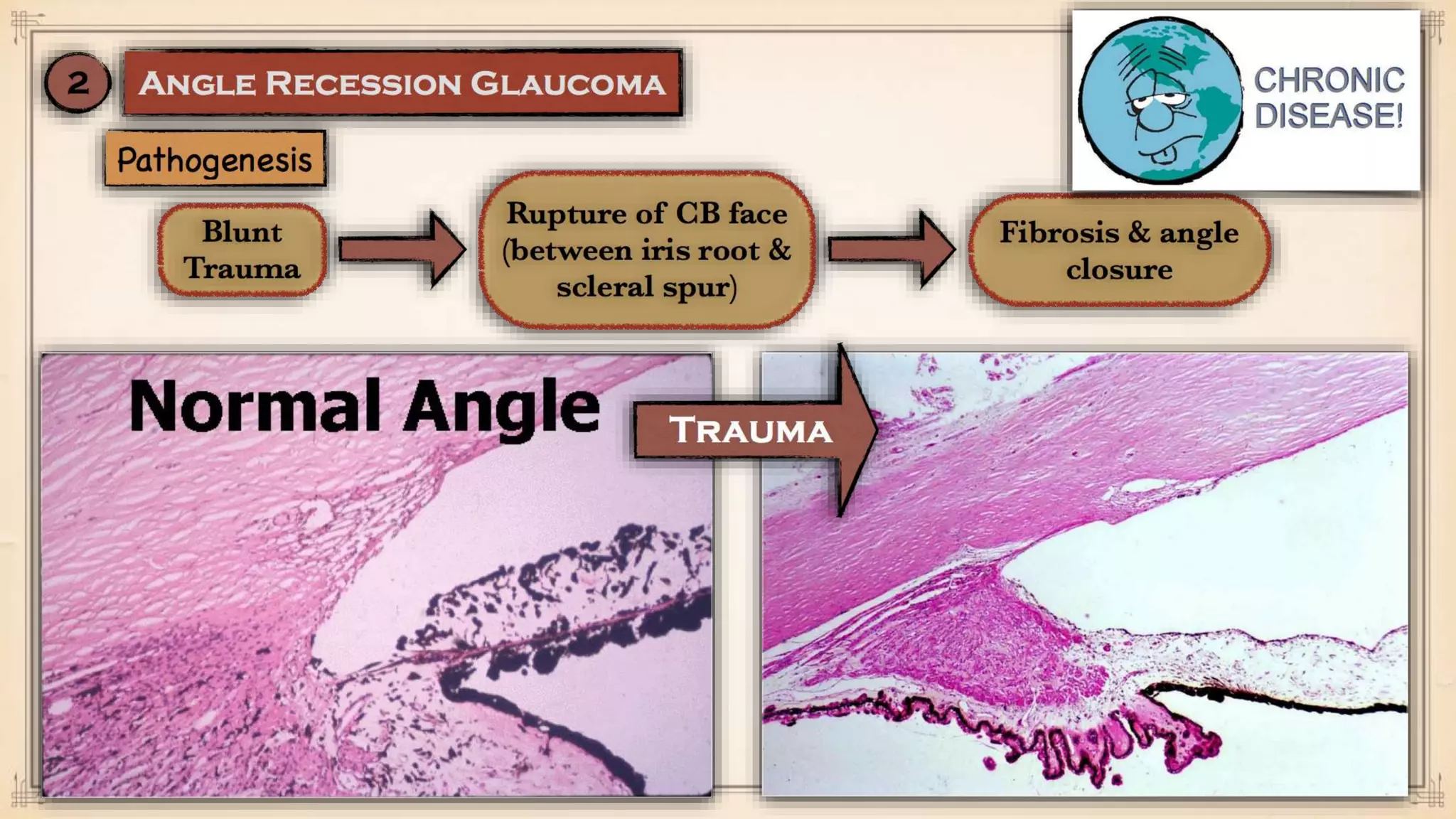 2ry angle closure glaucoma | PPTX