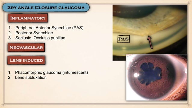 2ry angle closure glaucoma | PPT