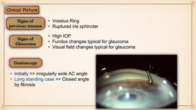 2ry angle closure glaucoma | PPT