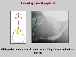 2 stage urethroplasty | PPT