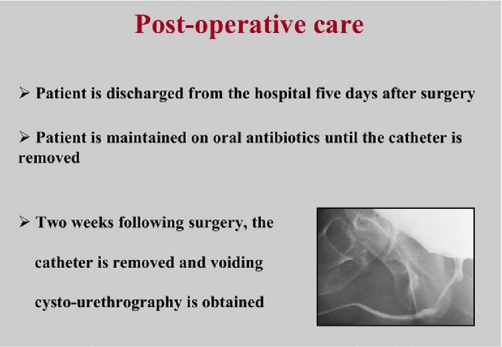 2 stage urethroplasty using oral mucosa