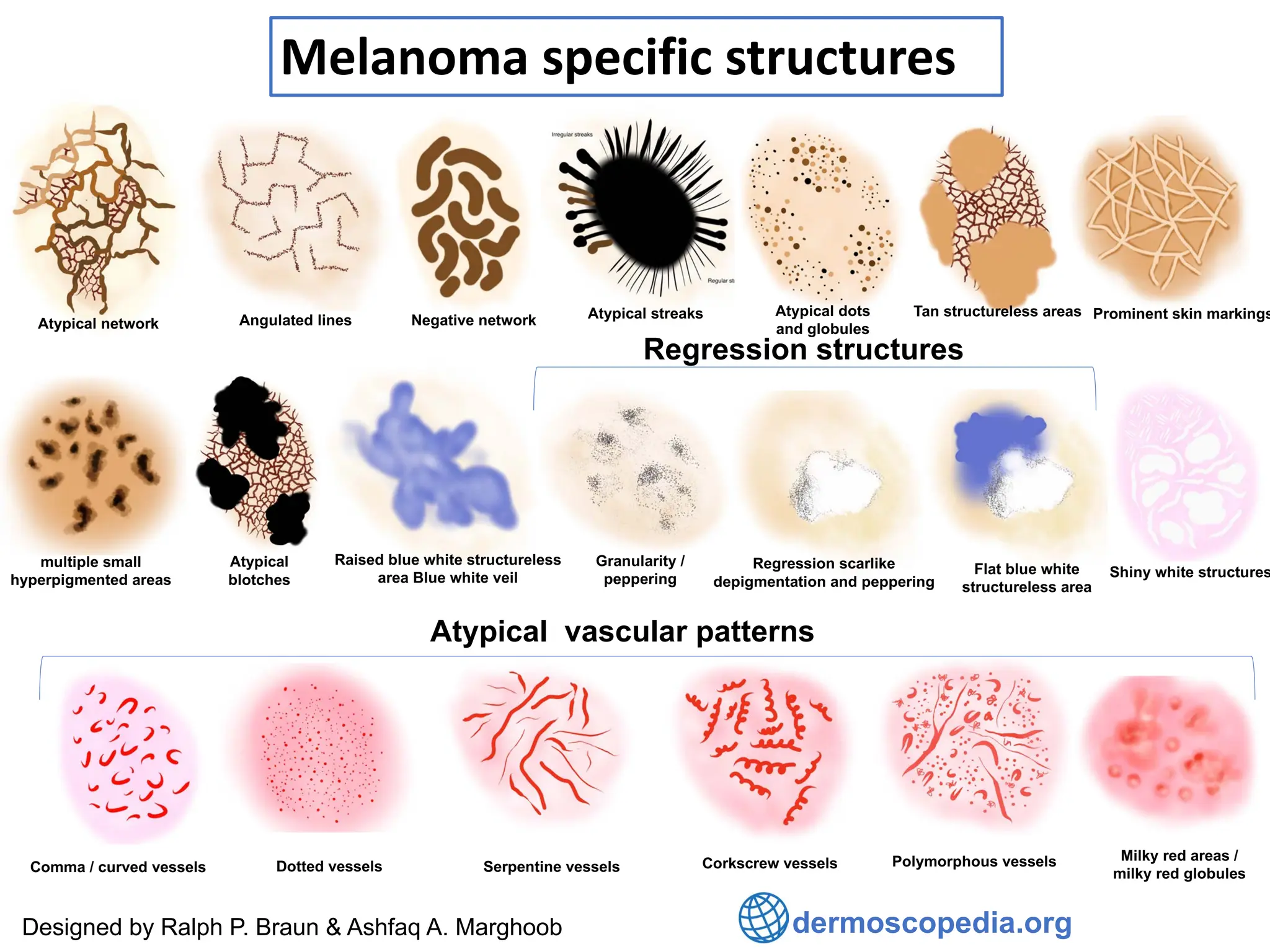 Características dermatosocpicas lesiones malignas dermoscopedia.org
