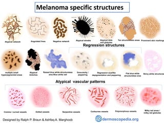 Características dermatosocpicas lesiones malignas dermoscopedia.org