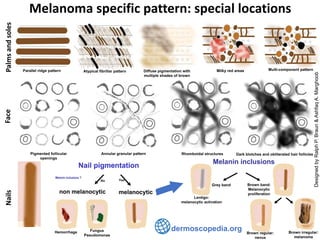 Características dermatosocpicas lesiones malignas dermoscopedia.org