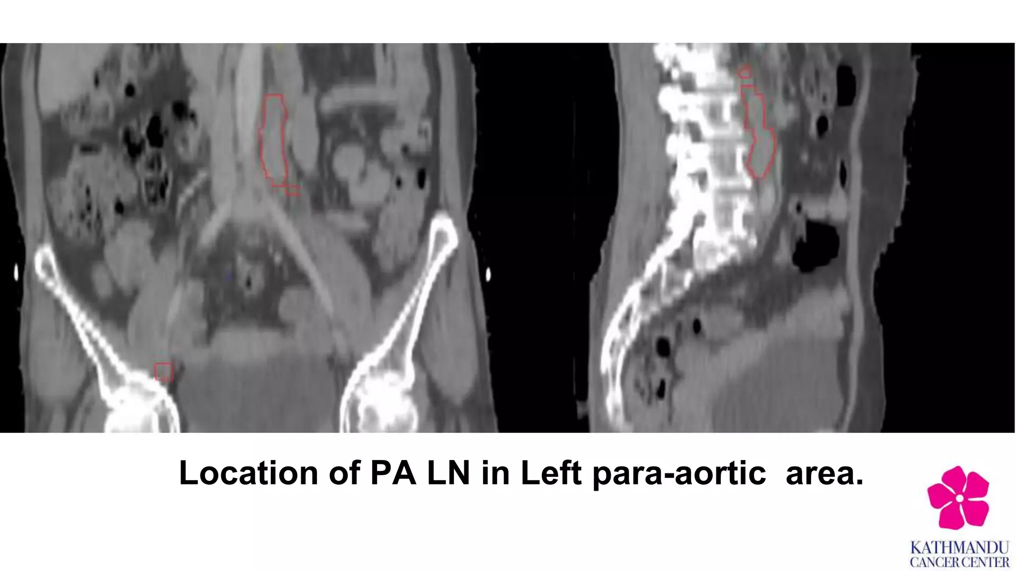 Extended field Radiotherapy with chemotherapy in treatment of cervical ...