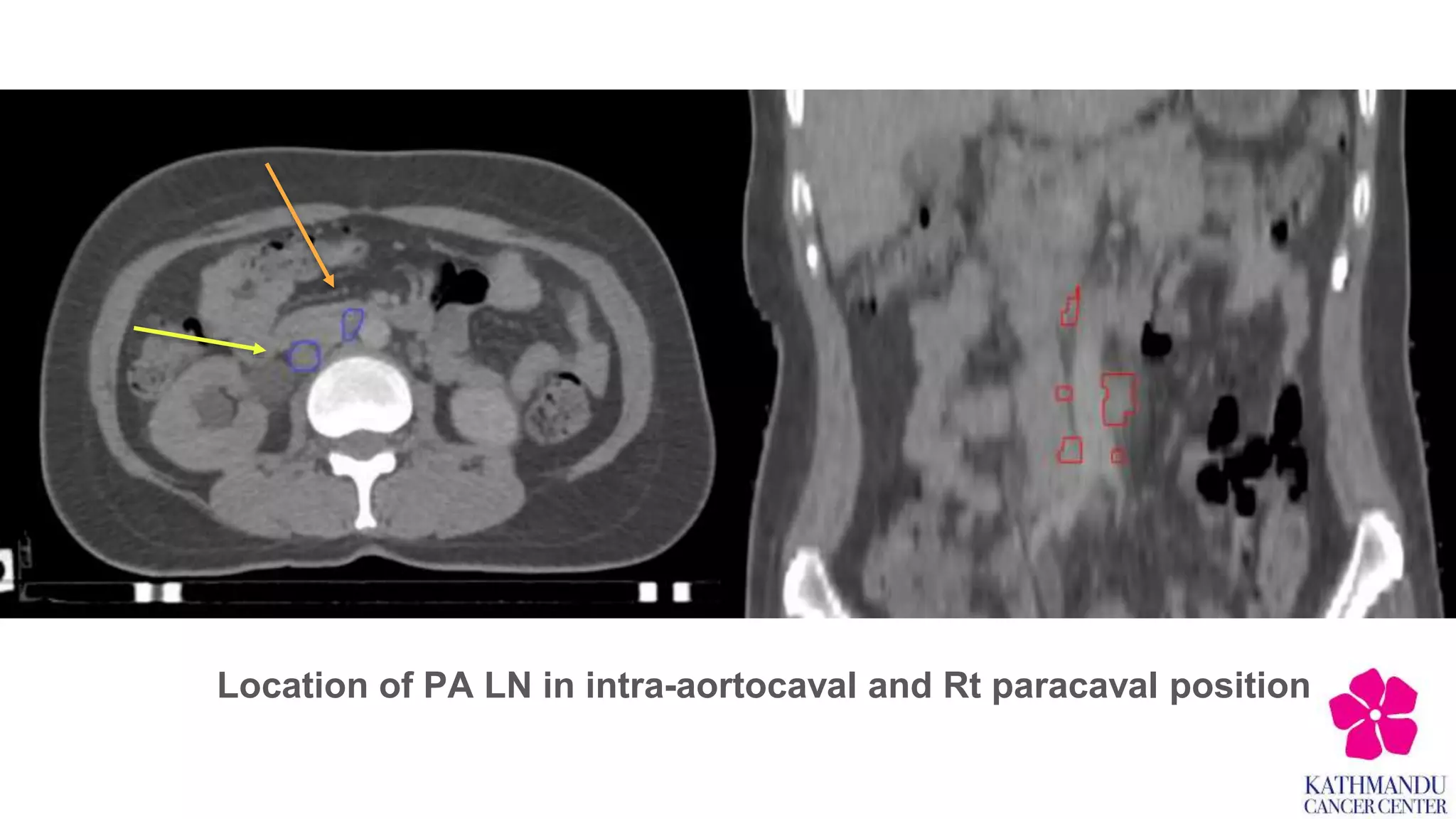 Extended field Radiotherapy with chemotherapy in treatment of cervical ...
