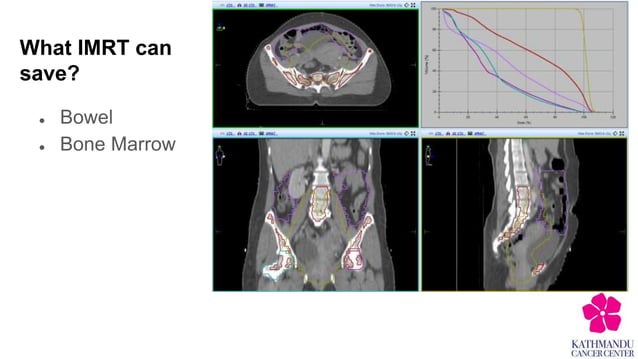 Extended field Radiotherapy with chemotherapy in treatment of cervical ...