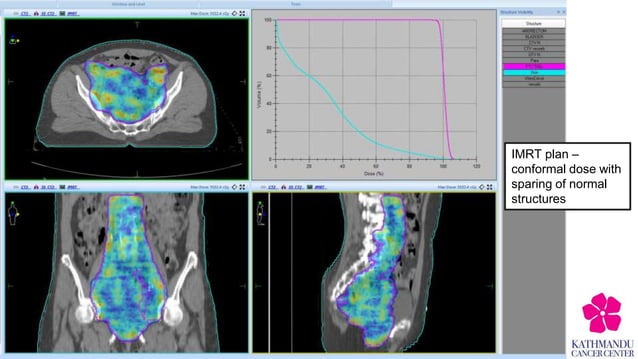 Extended field Radiotherapy with chemotherapy in treatment of cervical ...