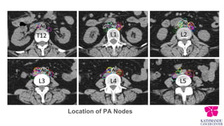 Extended field Radiotherapy with chemotherapy in treatment of cervical ...