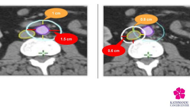 Extended field Radiotherapy with chemotherapy in treatment of cervical ...
