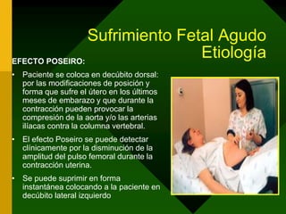 2) sufrimiento fetal agudo | PDF