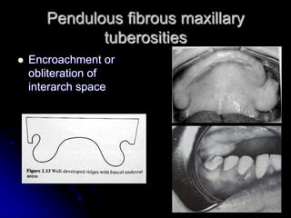 Fibrous Maxillary Tuberosity